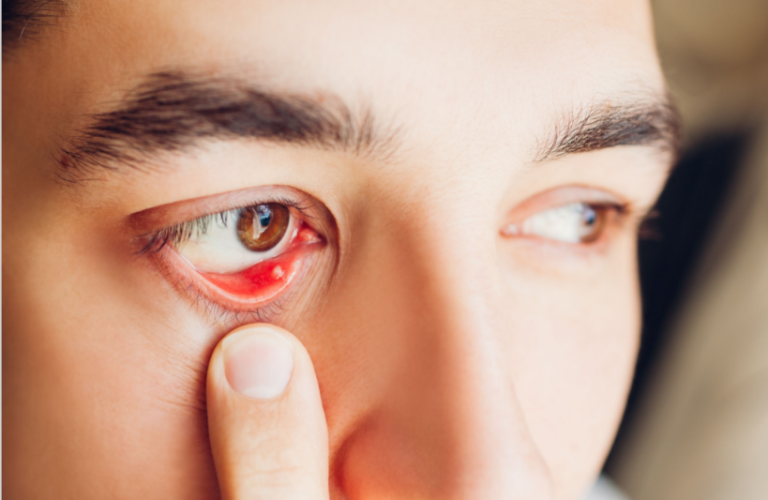 How to Unclog Meibomian Glands? | West Shore Eye Care